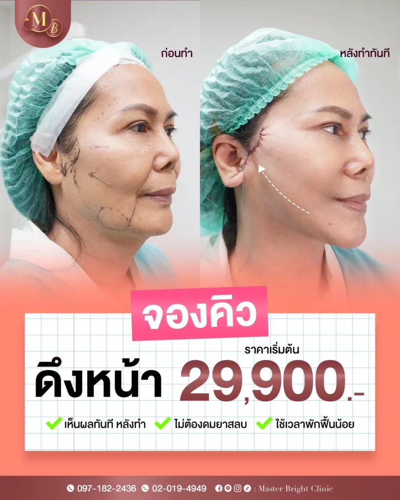 ศัลยกรรมดึงหน้า - masterbrightclinic