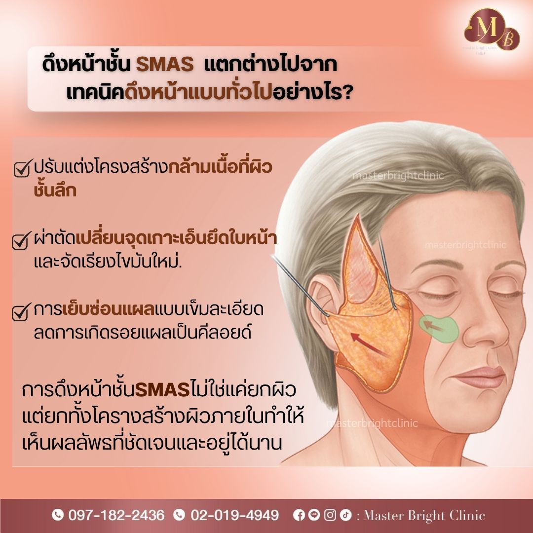 ดึงหน้าชั้น SMAS คืออะไร? - masterbrightclinic